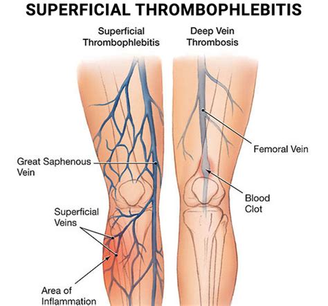 Superficial Thrombophlebitis Treatment In NYC NJ Vein Care Center