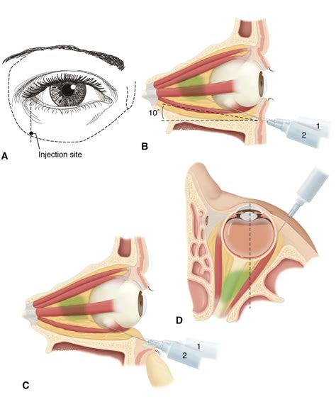 Retrobulbar Block American Academy Of Ophthalmology