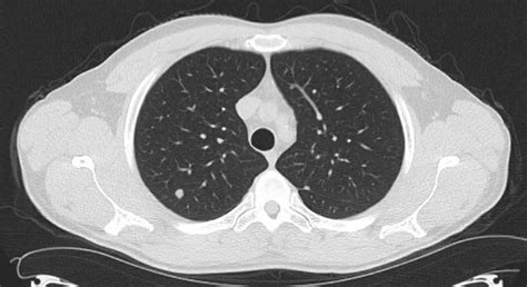 A Collaborative Solution To Lung Nodule Management