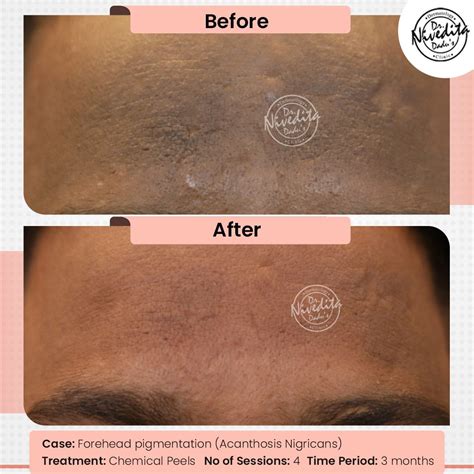 Acanthosis Nigricans Forehead