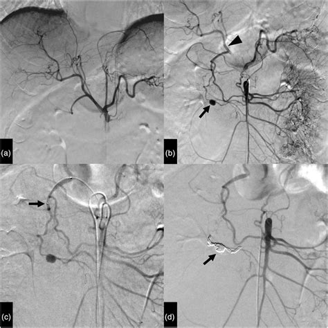 Transcatheter Arterial Embolization In A 53 Year Old Man Presenting