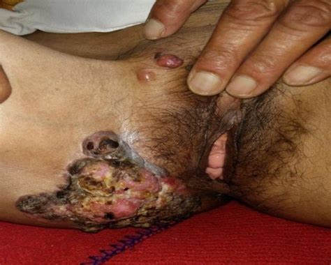 Initial Two Papular Lesion Over Upper Perigenital Area A And Large