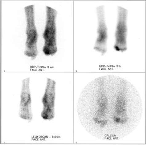 Osteomyelitis Bone Scan