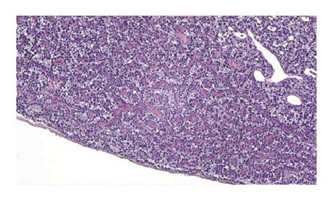 Parathyroid Adenoma A The Patient Underwent Minimally Invasive Download Scientific Diagram