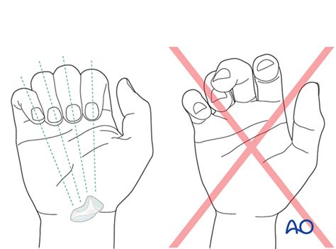 Intramedullary K Wire Fixation For Extraarticular Fracture Of The
