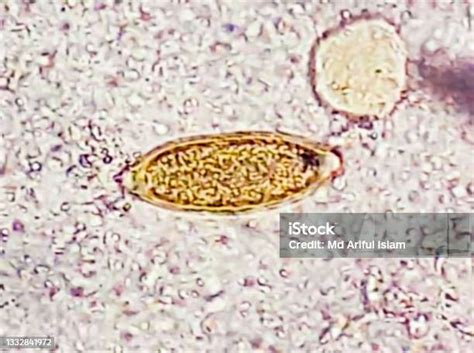 Telur Trichuris Trichiura Parasit Dalam Sampel Tinja Dianalisis Dengan