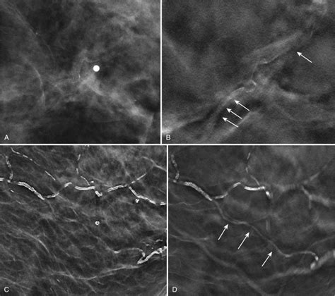 Mammographic Analysis Of Breast Calcifications Clinical Tree