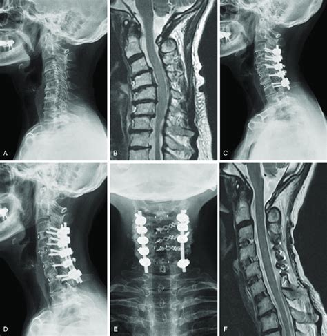 A 66 Year Old Woman Received C3 7 Acdf With Peek Cages Pif With C3 6