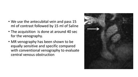 Anatomy Embryology And Imaging Of Svc Pptx