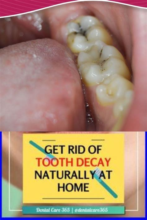 60 Seconds Dental Trick To Reverse Cavities And Heal Tooth Decay