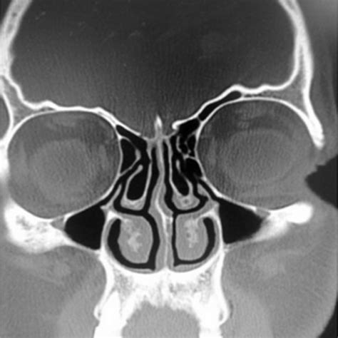 Bilateral Extensive Concha Bullosa Download Scientific Diagram