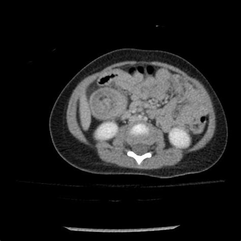 Target Sign Intussusception Pacs