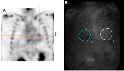 Bone Scintigraphy A Anterior Planar Images From The Patients Tc 99m Download Scientific