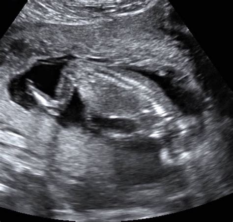 Transverse Fetal Spine Ultrasound