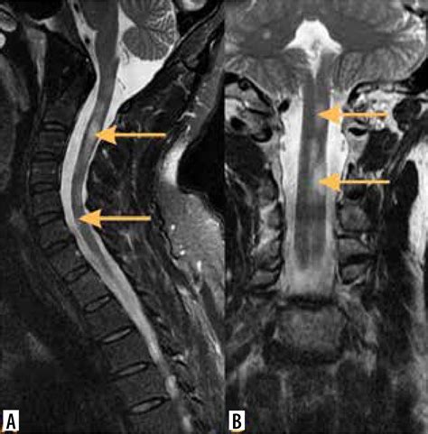 Imaging Of Intramedullary Tumours Of The Spinal Cord