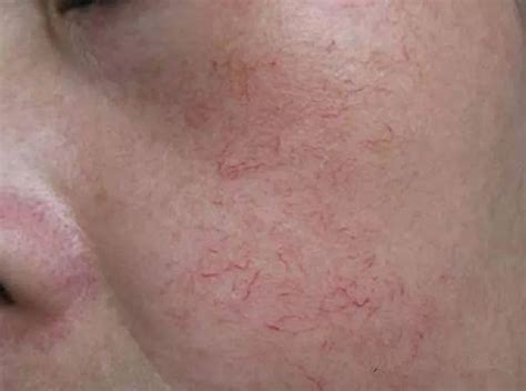 脸上毛细血管扩张图片 毛细血管扩张初期图片 伤感说说吧