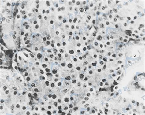 胰岛肿瘤 内分泌学 天山医学院