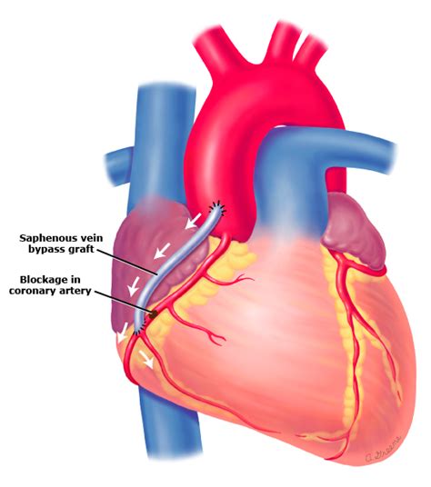 Vein And Artery Bypass Grafts Are Attached To The Heart Assessment Of