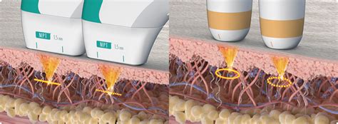 Ultraformer Mpt Skin Tightening Treatment Clinic 1 Auckland