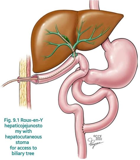 Hepaticocutaneous Jejunostomy •the Use Of Intestinal Stomas In Hepatobiliary Surgery Has