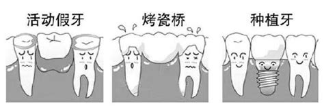 镶牙和种牙到底有什么区别 爱康健齿科