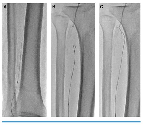 Limb Salvage Endovascular Technique In Chronic Limb Threatening