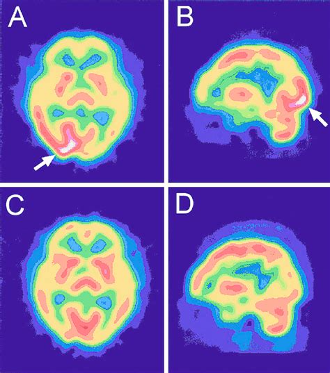 Ictal A And Interictal B Brain 99mtc Spect In The Patient Ictal