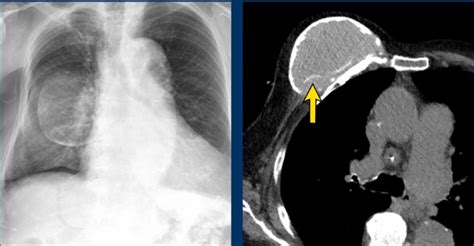 The Radiology Assistant Breast Implants