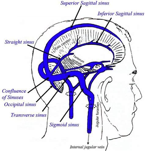 Sigmoid Sinus