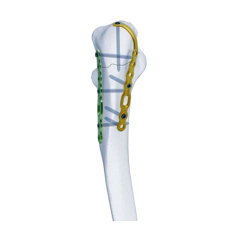 Olecranon Locking Plate Medical Device And Implants Manufacturer Double
