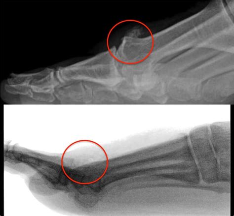 Hallux Rigidus Arthrodesis