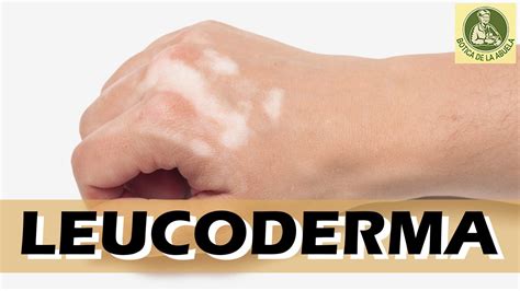 Pomada Para Leucodermia Gutata Braincp