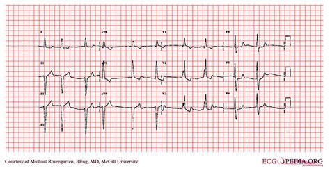 Right Bundle Branch Block EKG Examples Wikidoc