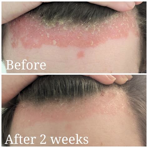 2 Week Progress On Cimzia Rcimzia
