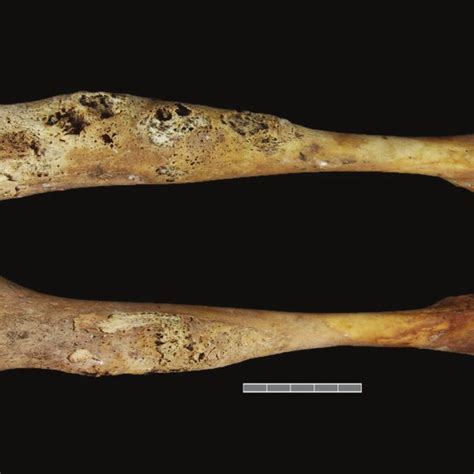 St Georges Cemetery 2006 Adult Female Exhibiting Caries Sicca On The Download Scientific