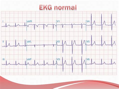¡cardiologia De Capos Electrocardiograma Ekg