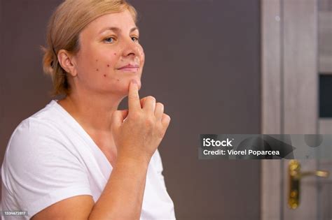 얼굴에 여드름 질환이 있는 흰색 티셔츠를 입은 금발 여성의 사진이 턱에 검지 손가락을 대고 있습니다 T 셔츠에 대한 스톡 사진