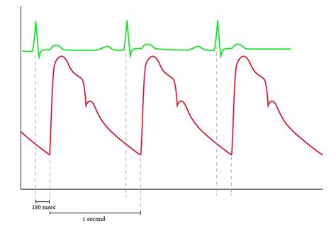 Abnormal Ekgs And Corresponding Arterial Waveforms Images