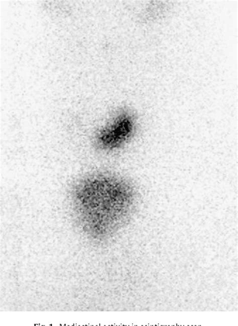 Figure 3 From The Forgotten Goiter After Total Thyroidectomy