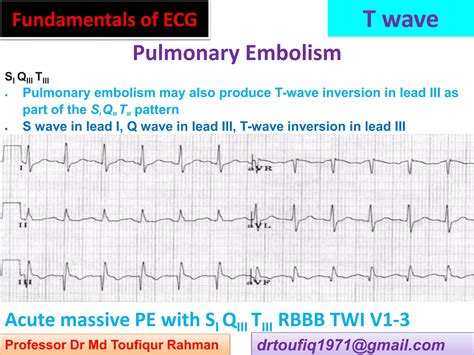 Approach To A Patient With T Wave Abnormality In Ecg Ppsx