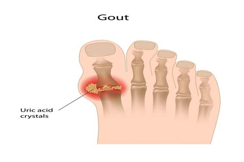 Definition Symptoms Causes Diagnosis Types Pathophysiology