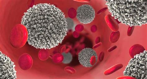 Leucemia Mieloide Aguda El Cáncer Que Se Esconde En La Sangre