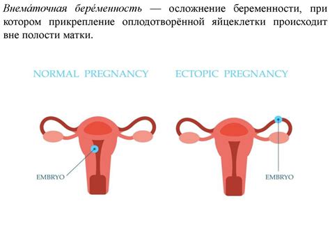 Внематочная беременность презентация онлайн