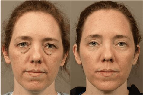 Tear Trough Implant For Youthful Rested Eyes