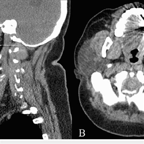Ct Head Without Contrast Facial Anomalies Evident In Femoral Facial