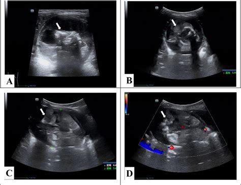 Ultrasonographic Images A C Ultrasound Images Show A Mixed Density