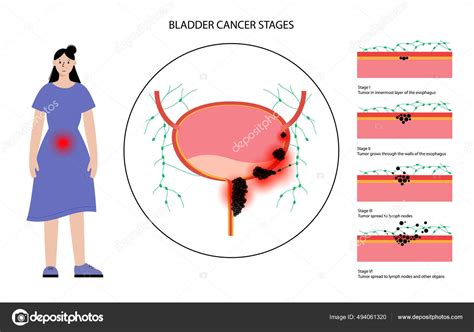 Bladder Cancer Stages Stock Vector Image By ©pikovit 494061320