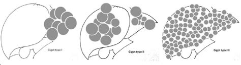 Gigots Classification Of Polycystic Liver Disease Download