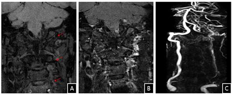 Diagnostics Free Full Text Vertebral Artery Dissection Following