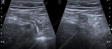 Appendicitis Ultrasound Scan Stock Image F042 7335 Science Photo